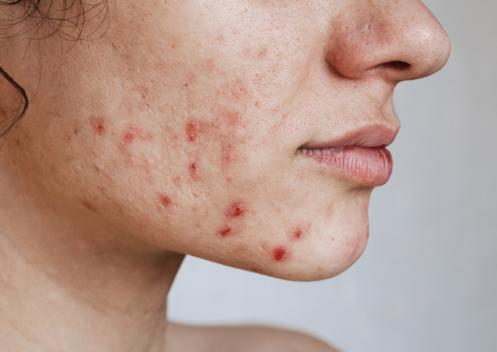 Acne Treatment - SRGN Clinic