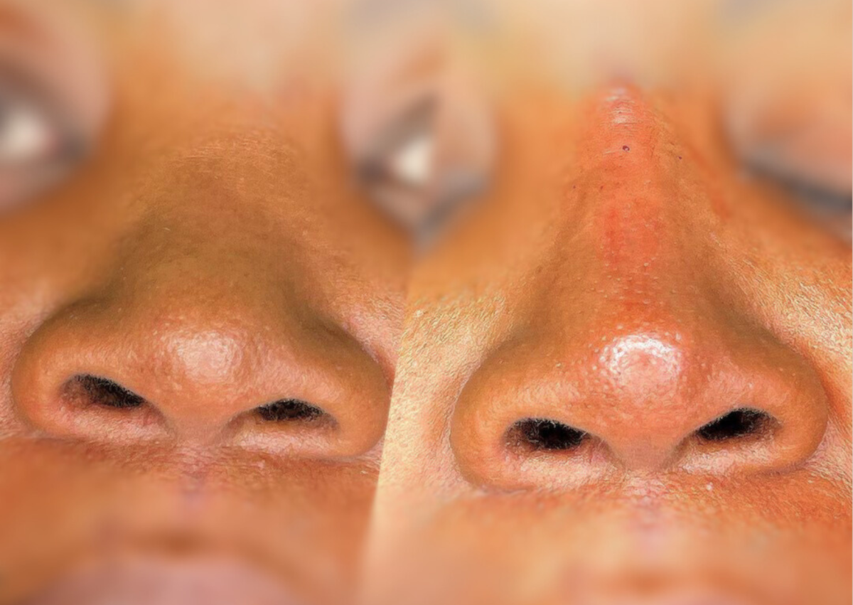 Non-Surgical Rhinoplasty for Wide Nose - SRGN Clinic