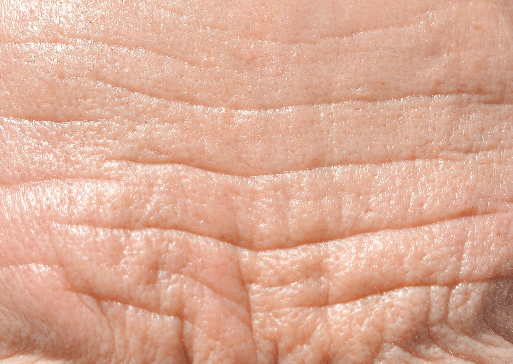 Fine Lines and Wrinkles - SRGN Clinic