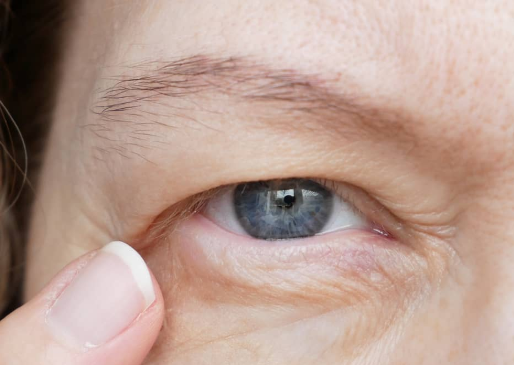 Eyelid Hooding and Loose Skin - SRGN Clinic
