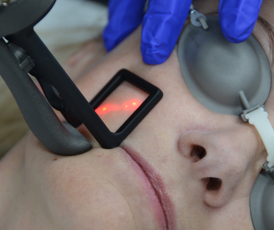 CoolPeel Laser - SRGN Clinic