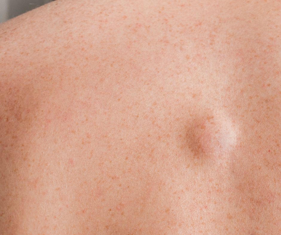 Lipoma Removal - SRGN Clinic